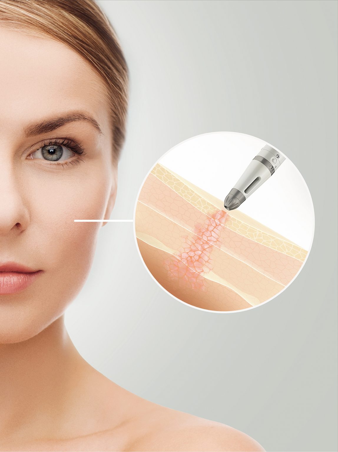 DERMADROP Softlifting #1 | EXKLUSIV Braunschweig